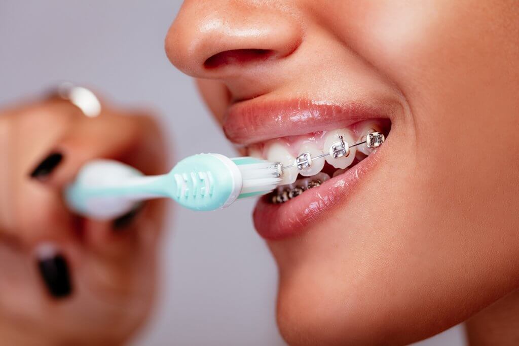 How Do You Brush Your Teeth With Braces? - TenderSmiles4Kids